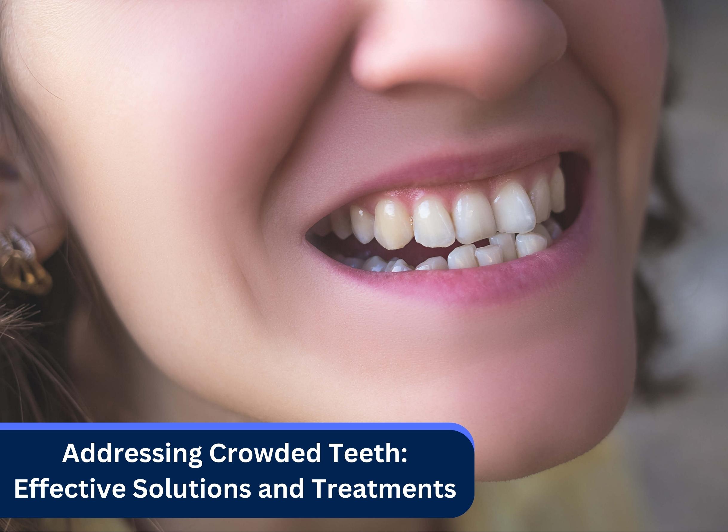 Addressing Crowded Teeth Effective Solutions And Treatments
